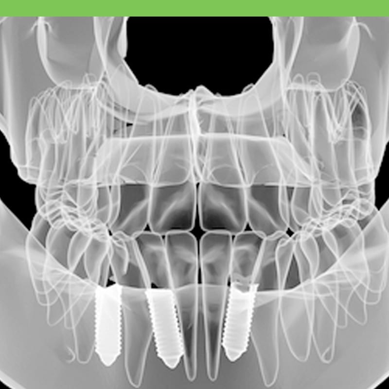 Computer Guided Dental Implant Surgery - Costa Rica Dental Guide to ...