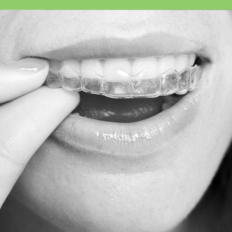 Clear Orthodontic Aligners - Costa Rica Dental Guide to Best Dentists