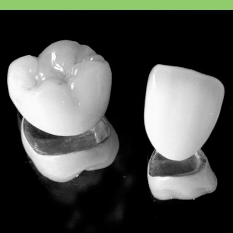 PFM: Porcelain Fused to Metal - Costa Rica Dental Guide to Best Dentists