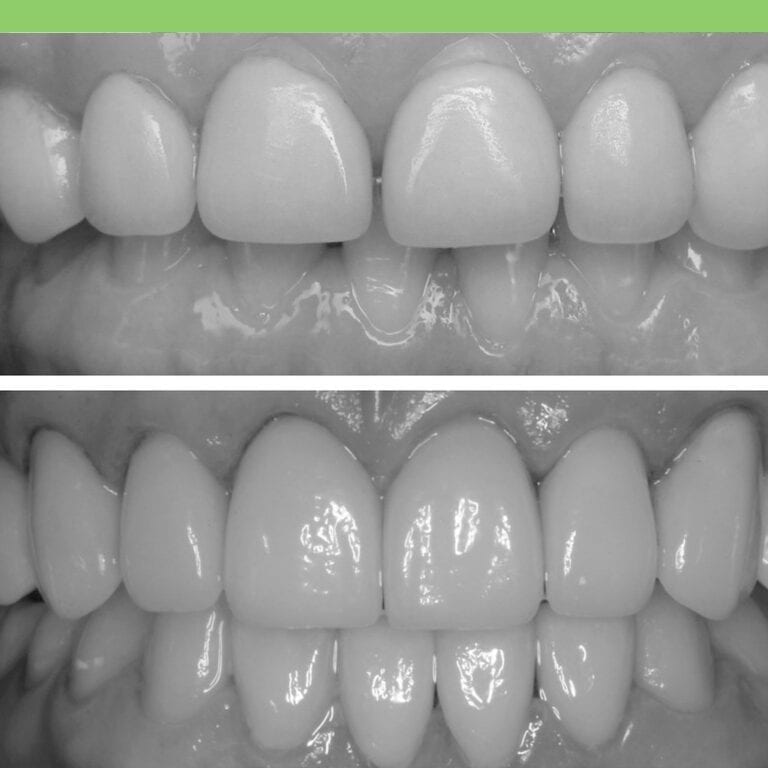 Tooth Contouring & Reshaping - Costa Rica Dental Guide to Best Dentists