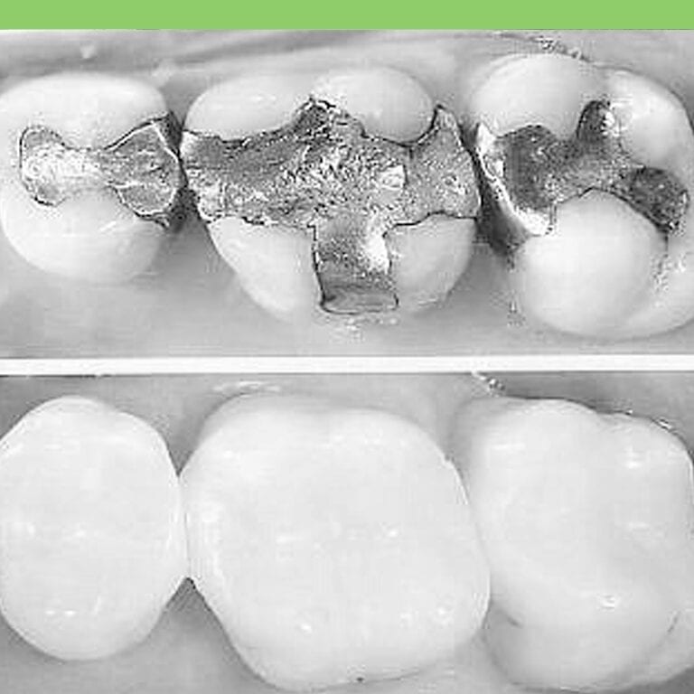 Tooth Colored Fillings (Composite Resin) - Costa Rica Dental Guide to ...