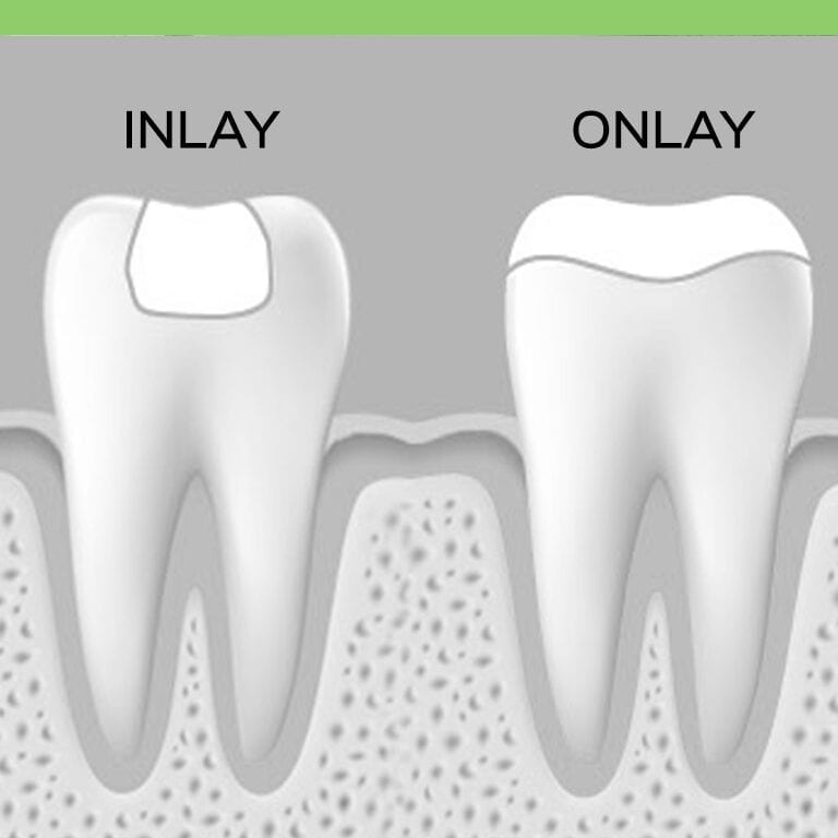 Inlays & Onlays - Costa Rica Dental Guide to Best Dentists